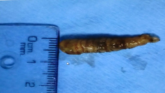 Human botfly worm
