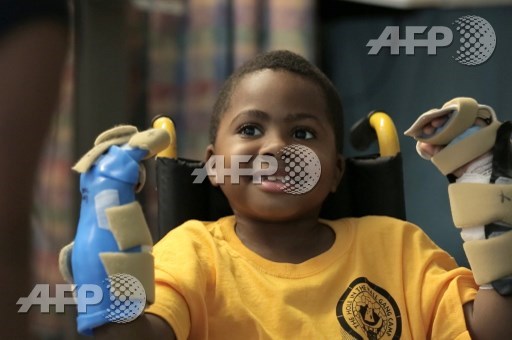 World's first child hand transplant a 'success'