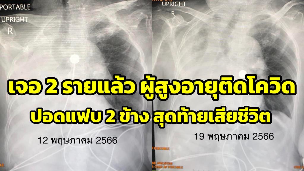 'หมอมนูญ' เผยพบผู้สูงอายุติดโควิด XBB เจอปอดแฟบแล้ว 2 ราย