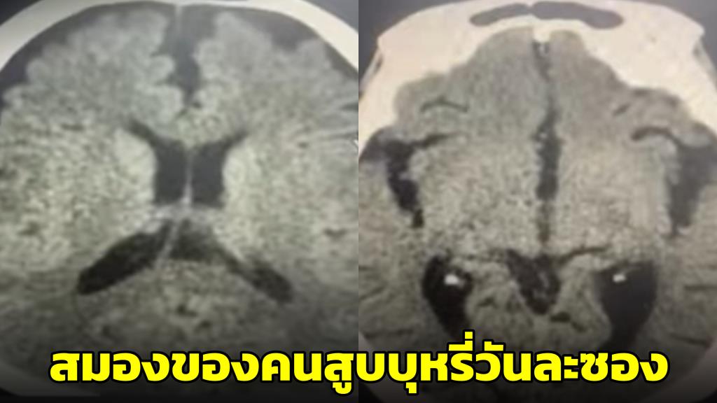 The Shocking Effects of Smoking on the Brain: Dr. Pracha Reveals X-Ray ...